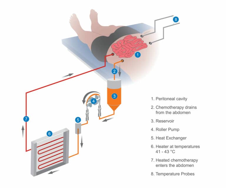 Bauchfell: Symptome & Behandlung - Isar Klinikum Chirurgie